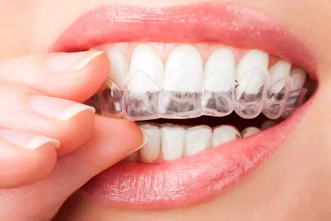 Голлівудська усмішка: 5 способів зробити зуби білосніжними 37173_2